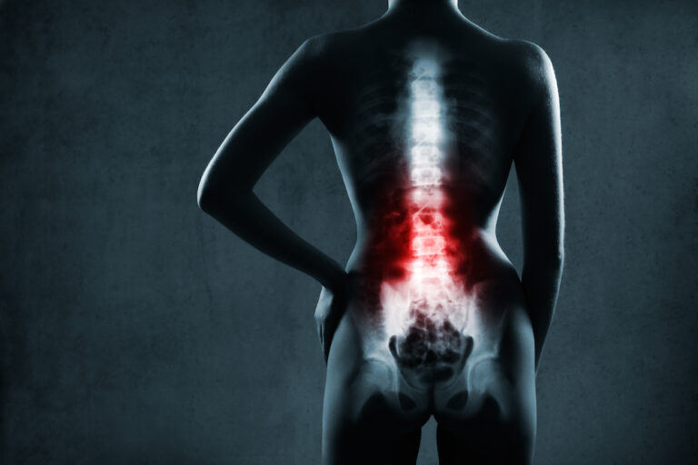 Back Pain After Rear-Ended: Causes, Symptoms, and Treatment ...